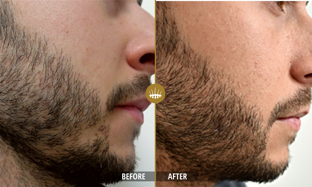 Male hair loss - Hair Science Indonesia