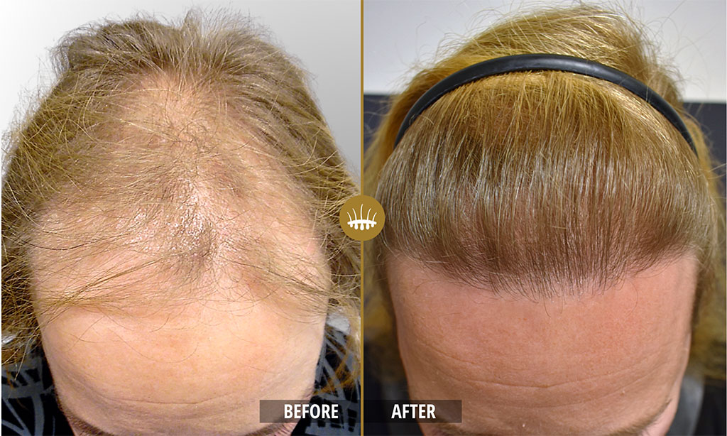 Hair transplantation for women - HASCI Jakarta